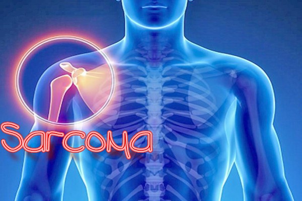 ¿Qué es el sarcoma? - Good Neighbor Clinic