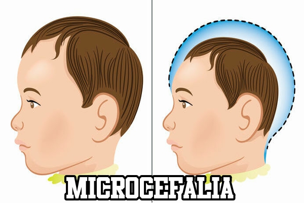 Microcefalia - Good Neighbor Clinic