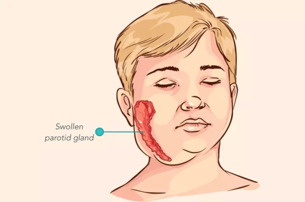 Parotitis - Good Neighbor Clinic